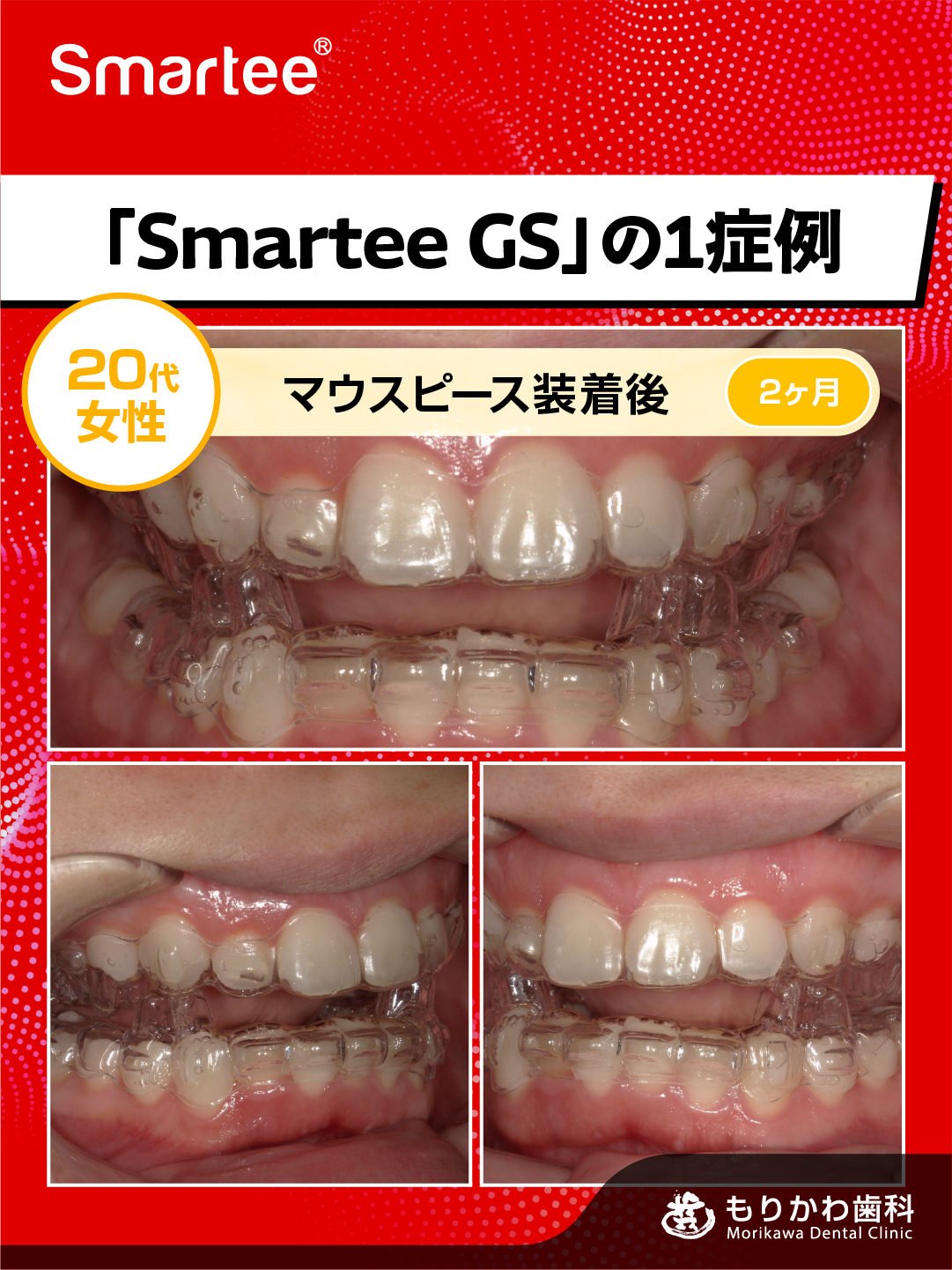 もりかわ歯科の新マウスピース矯正『Smartee』徹底解説｜インビザラインとの違いと最新治療法