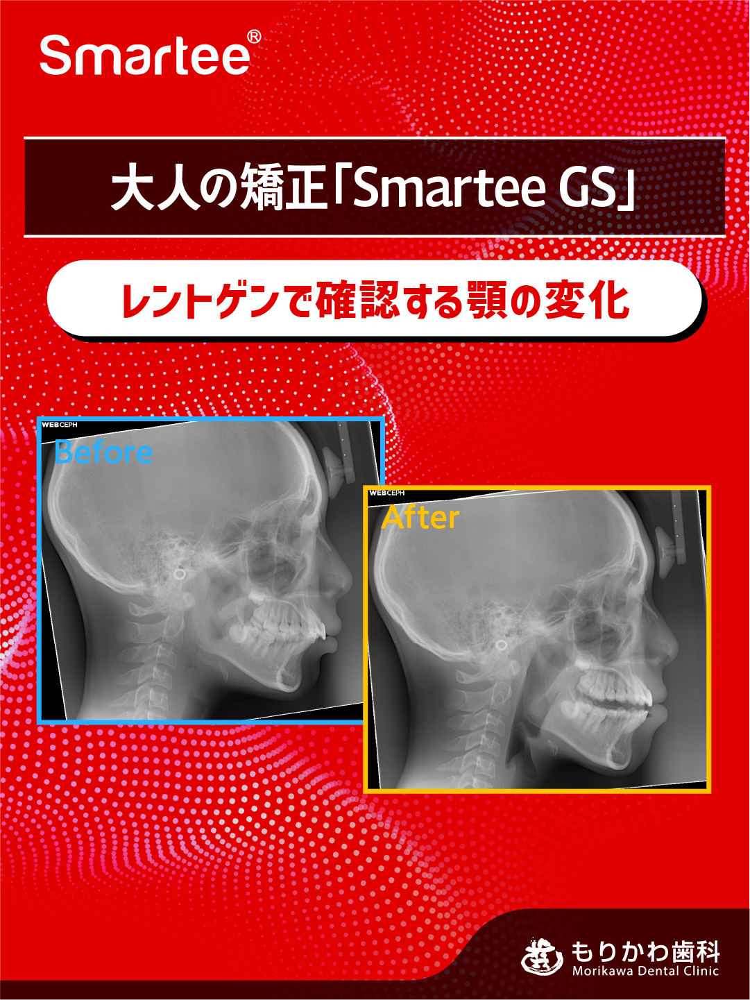 もりかわ歯科の新マウスピース矯正『Smartee』徹底解説｜インビザラインとの違いと最新治療法